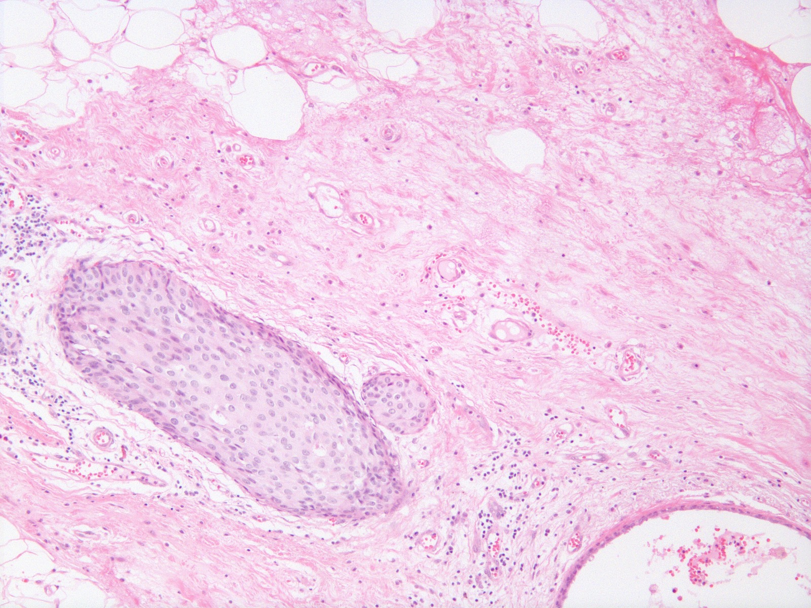 Human Breast Cancer FFPE Tissue Section (HS0003) | Applied Biological ...