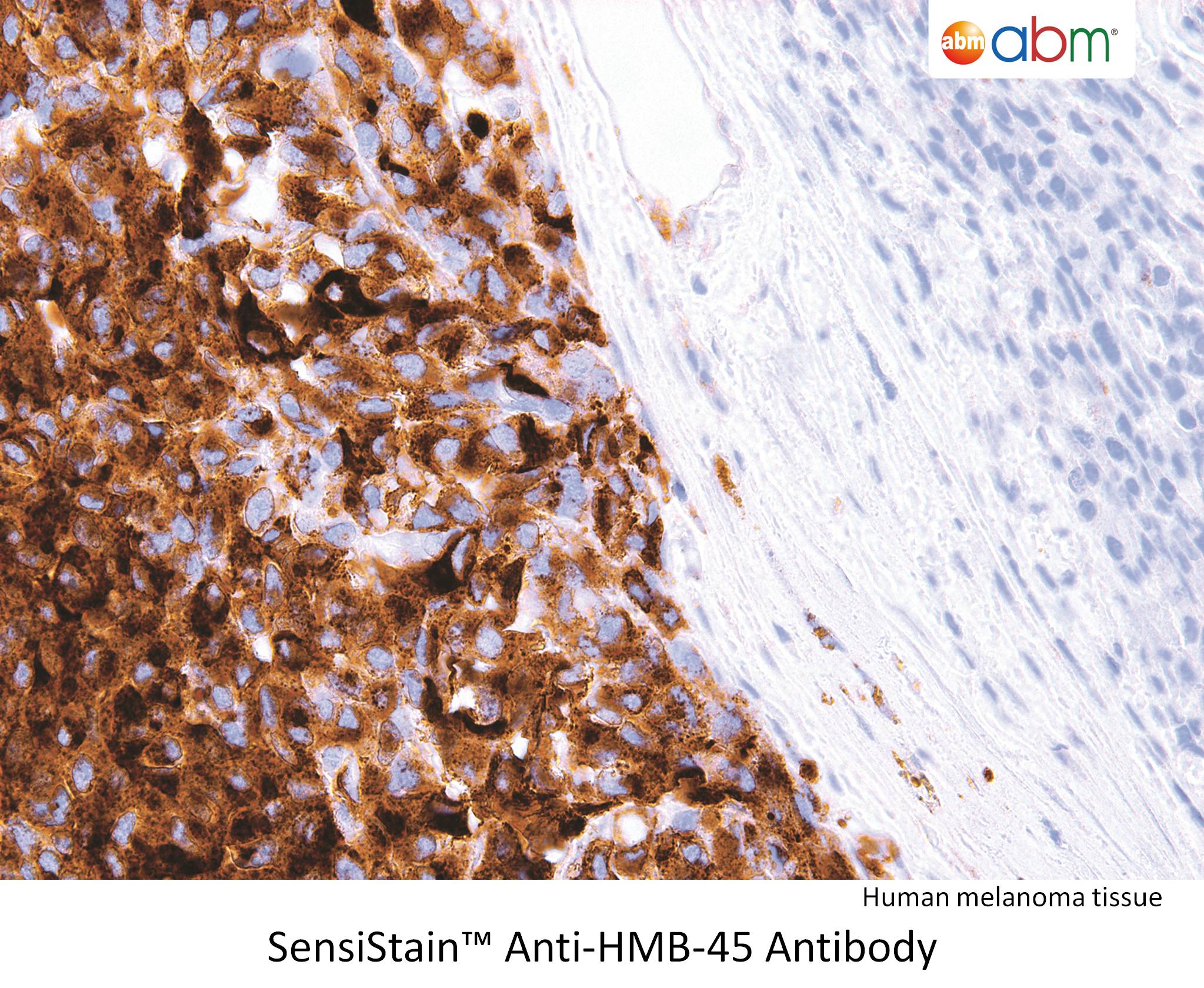 SensiStain Anti-HMB-45 Antibody | Applied Biological Materials Inc.